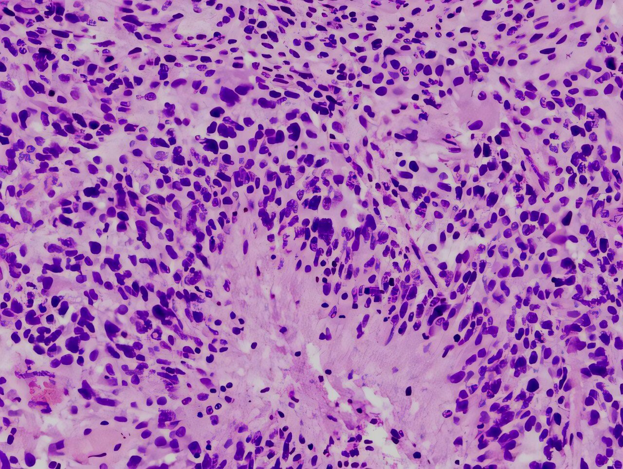 Glioblastoma: Symptoms, Diagnosis, and Treatment - Leading experts in ...